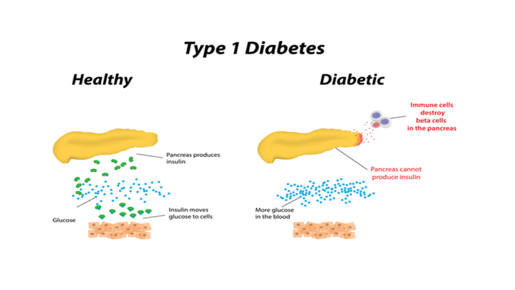 Exploring Diabetes: Explaining the Various Types and Their Root Causes ...